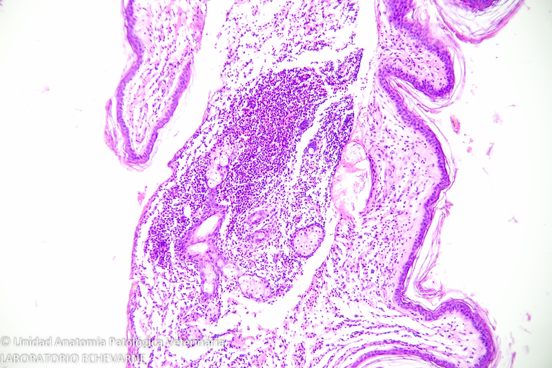 Eosinophilic Cellulitis Wells Syndrome In Association
